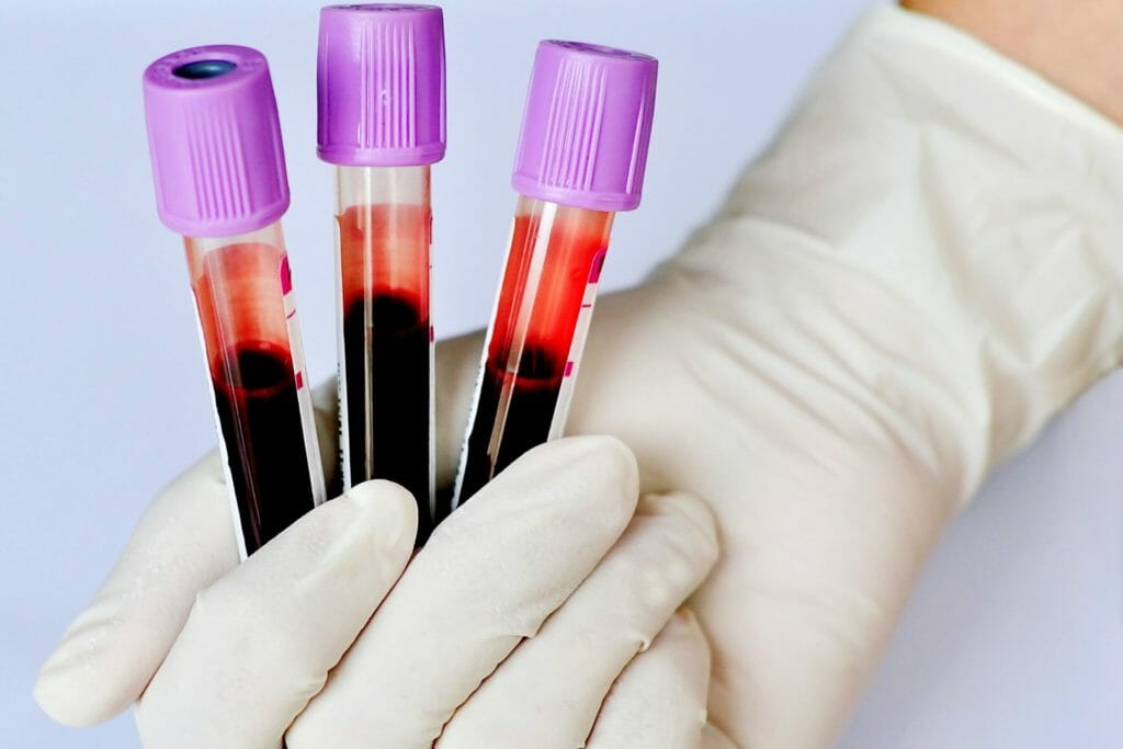 Ultimate Guide to Kidney Disease and Low Phosphorus Dieting - Avoid ...