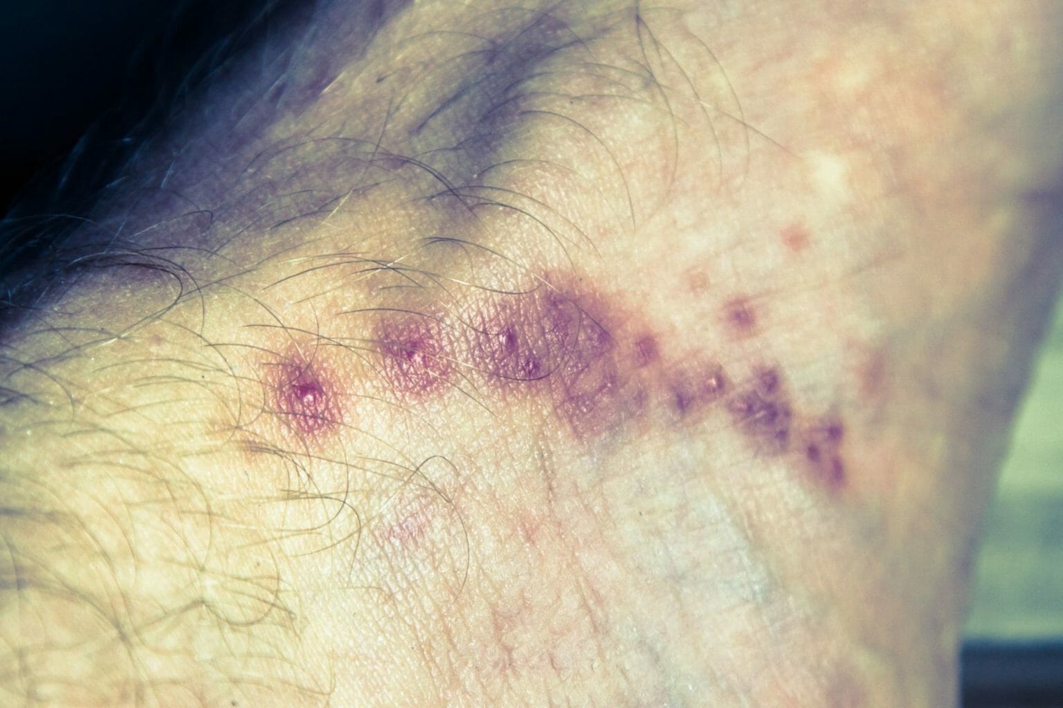 Skin Problems in CKD: How Kidney Disease Affects the Skin - Avoid ...